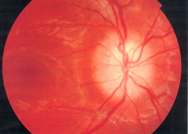 optic-disc-drusen-retina-image-bank