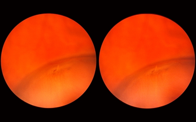 Elevated Lesion Retina Image Bank