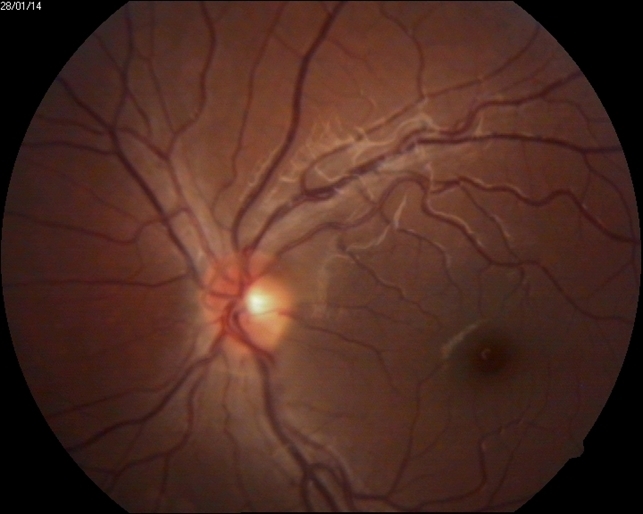 Remnant Of Hyaloidal Artery Retina Image Bank