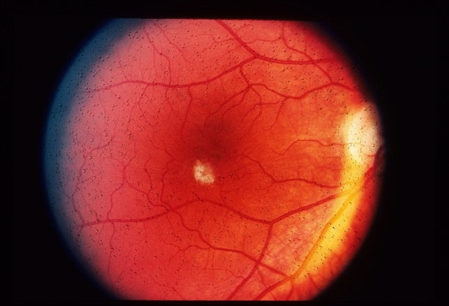 Right Macular Lesion Retina Image Bank