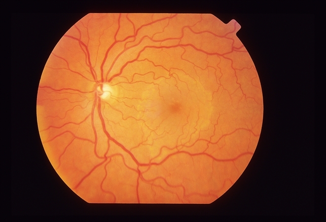Age Related Macular Degeneration With Occult Choroidal