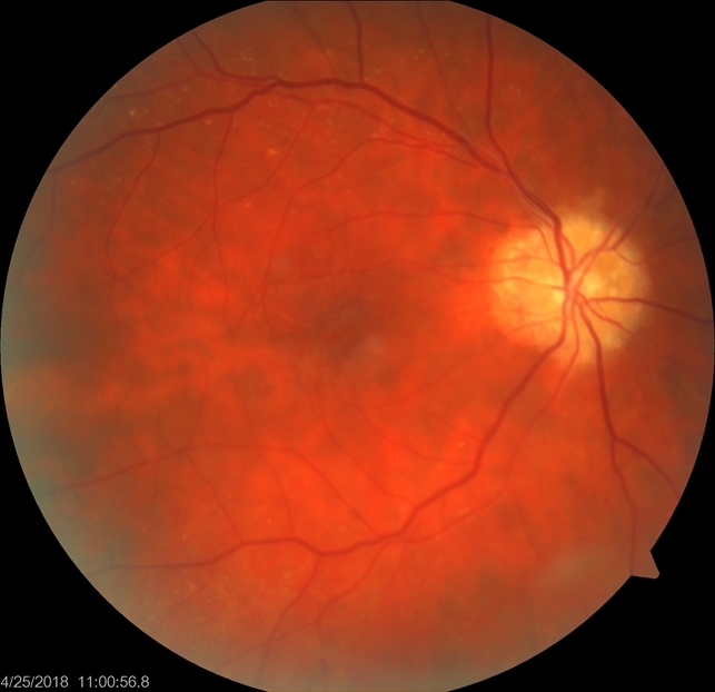 Color Fundus Photographs of Optic Disc Drusen - Retina Image Bank Color Fundus Photographs of Optic Disc Drusen - Retina Image Bank