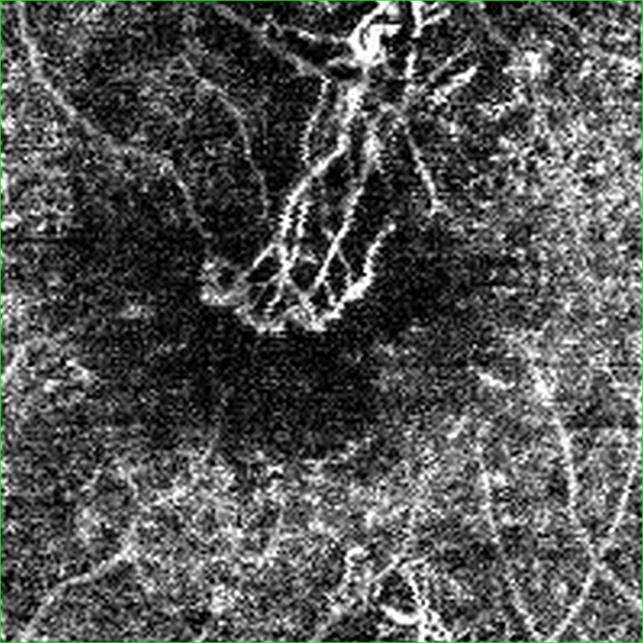 Active Cnvm On Angio Oct Retina Image Bank