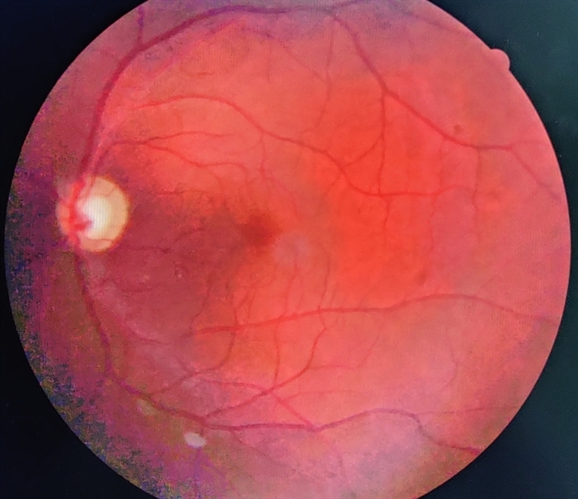 Non Glaucomatous Optic Disc Cupping Retina Image Bank