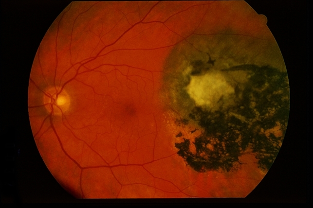 Choroidal Nevus with CNVM - Retina Image Bank Choroidal Nevus with CNVM - Retina Image Bank