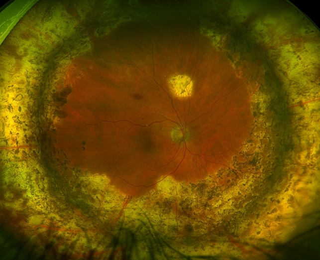 Scleral Buckle With 360 Degree Laser Retina Image Bank
