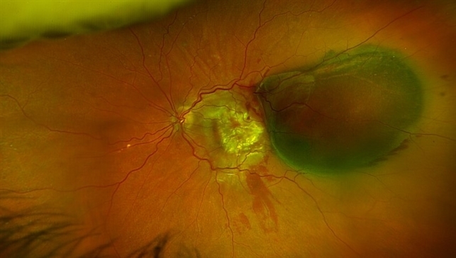 Hemorrhagic Choroidal Detachment Retina Image Bank