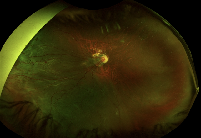 ROP related retinal detachment - Retina Image Bank ROP related retinal detachment - Retina Image Bank