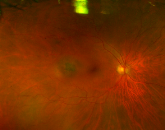 Choroidal Nevus - Retina Image Bank Choroidal Nevus - Retina Image Bank