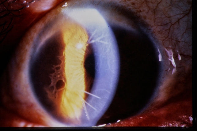 Lues Syphilis Ik Spiders Web Retina Image Bank