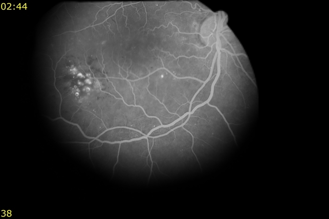 Retinal Cavernous Hemangioma Retina Image Bank