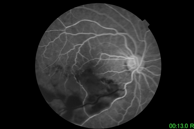 Capillary Non Perfusion Retina Image Bank 