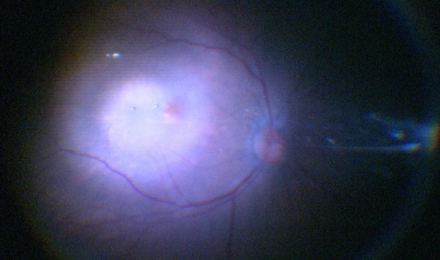 Remnant Of Hyaloid Artery Retina Image Bank