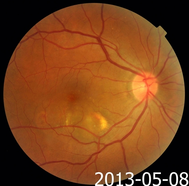 Polypoidal Choroidal Vasculopathy - Retina Image Bank Polypoidal Choroidal Vasculopathy - Retina Image Bank