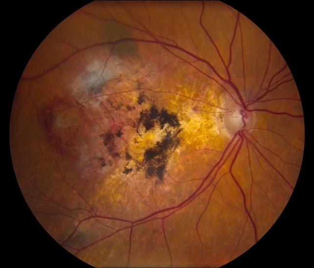 dry-macular-degeneration-with-hemorrhage-retina-image-bank