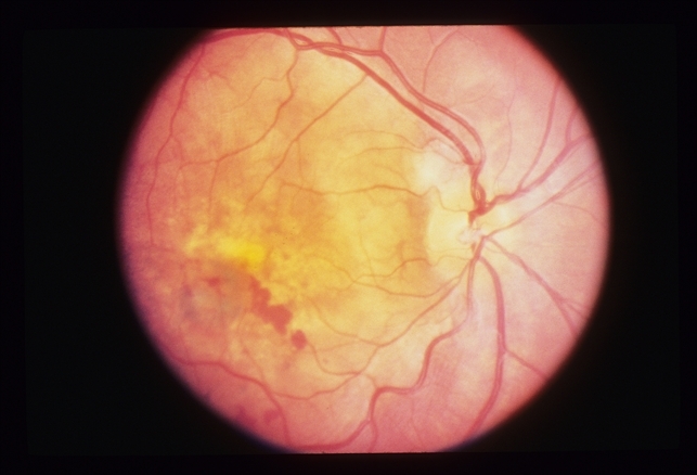 Central Lesion Retina Image Bank