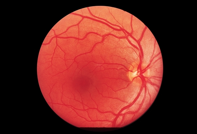 Accumulation Of Glial Tissue Retina Image Bank