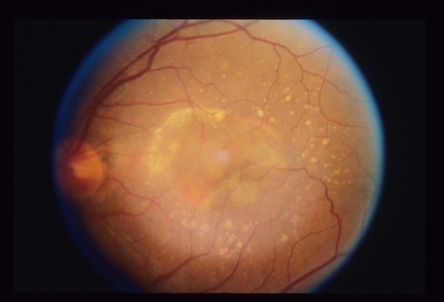 Occult Choroidal Neovascularization Cnv Retina Image Bank