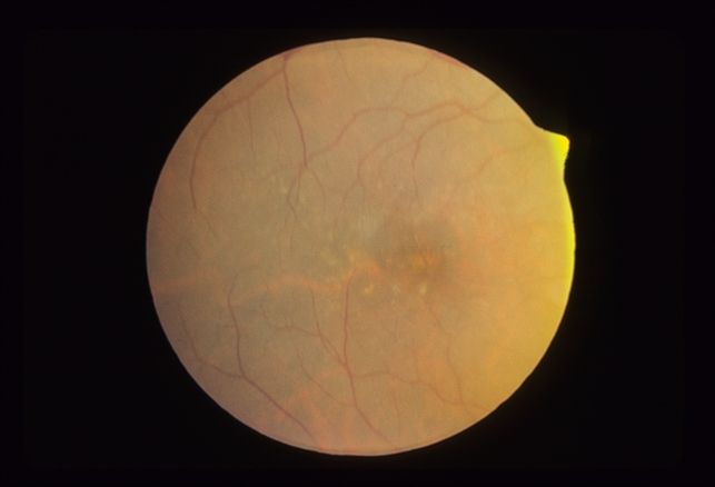 Age Related Macular Degeneration With Occult Choroidal