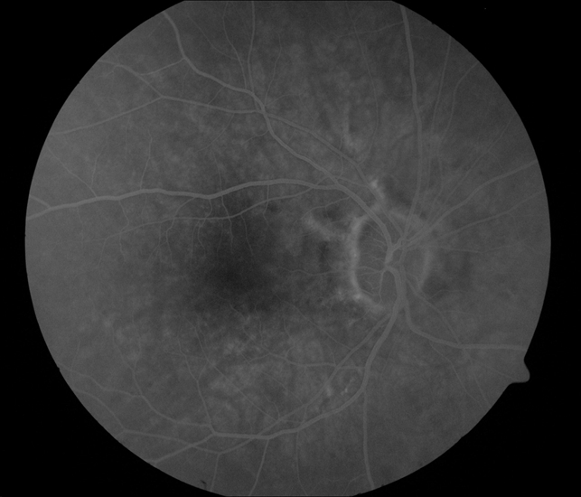 Pseudoxanthoma Elasticum Pxe Retina Image Bank