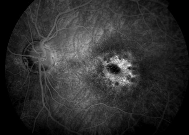 Macular Dystrophy Retina Image Bank macular-dystrophy-retina-image-bank