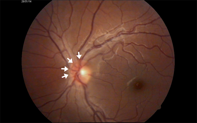 Remnant Of Hyaloidal Artery Retina Image Bank
