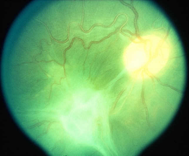 Toxocara Granuloma Retina Image Bank