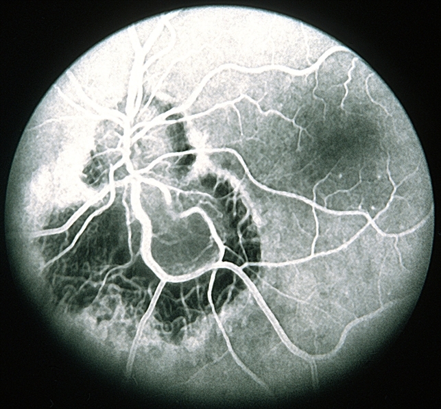 Toxocara Granuloma Retina Image Bank