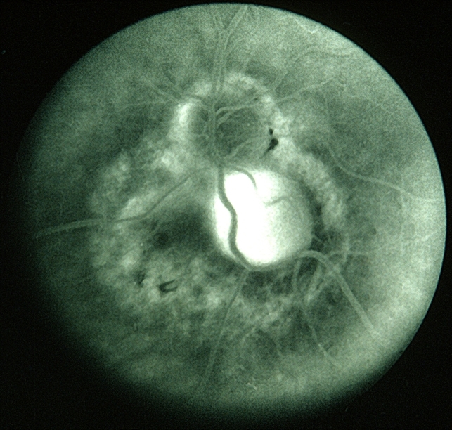 Toxocara Granuloma Retina Image Bank