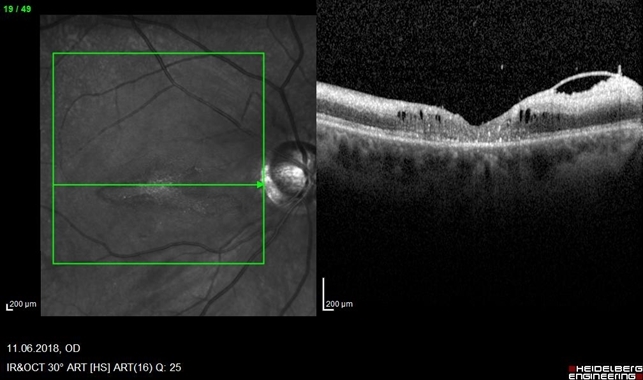 Disorganization of the Inner Retinal Layers - Retina Image Bank Disorganization of the Inner Retinal Layers - Retina Image Bank