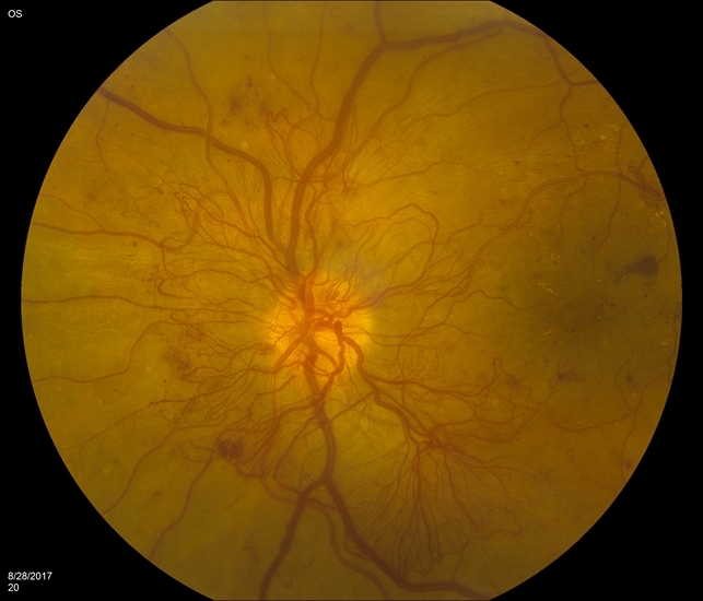 Severe NVD - Retina Image Bank Severe NVD - Retina Image Bank