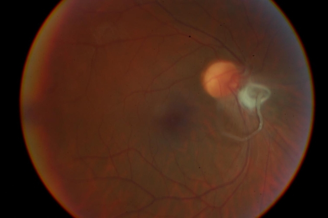 Persistence Of The Hyaloid Artery Retina Image Bank