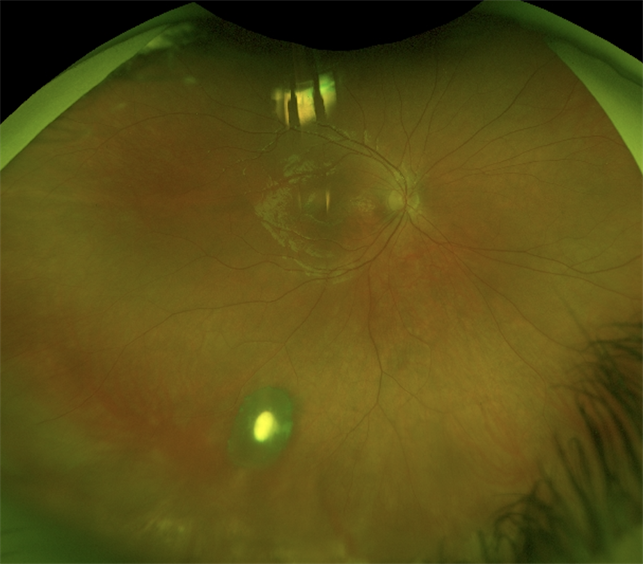 Intravitreal Parasitic Cyst - Retina Image Bank Intravitreal Parasitic Cyst - Retina Image Bank